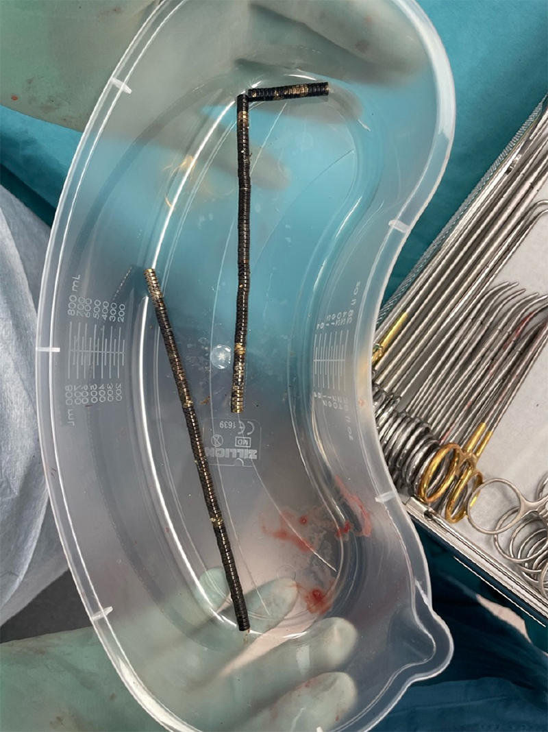 Boy who swallowed 100 magnets has surgery to remove them from his gut ...